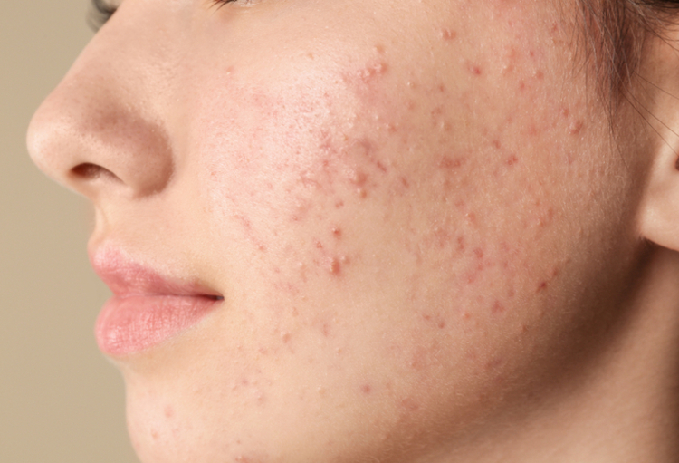 Matige acne behandelen met isotretinoïne in lage dosering?