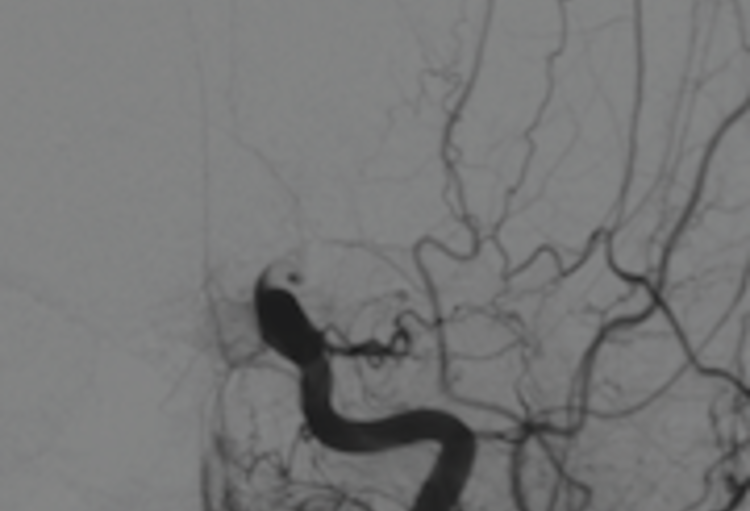 Thrombectomie mécanique après échec de la thrombolyse intraveineuse en ...