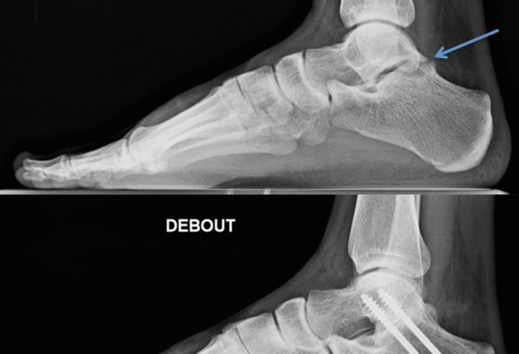 Arthrodèse sous-astragalienne par arthroscopie postérieure - Ortho-Rhumato