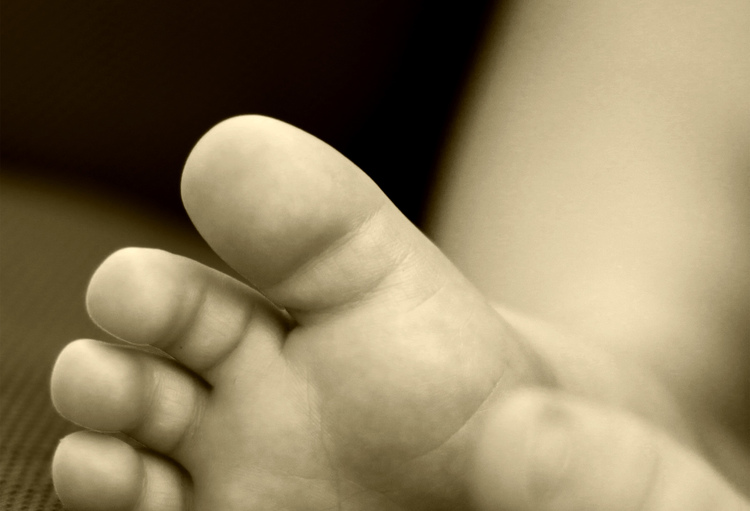 Affections du pied chez l’enfant et l’adolescent (2) - Ortho-Rhumato