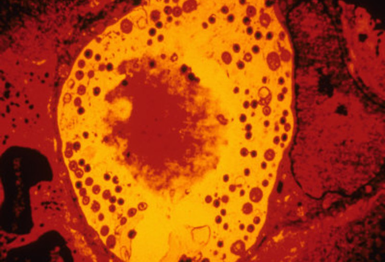 Pour un dépistage plus systématique des infections à Chlamydia ...