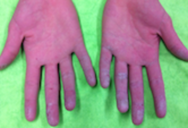 Un tableau étrange d’acrocyanose et de douleur au niveau des mains et ...