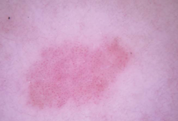 Tache rosée aspécifique - Skin