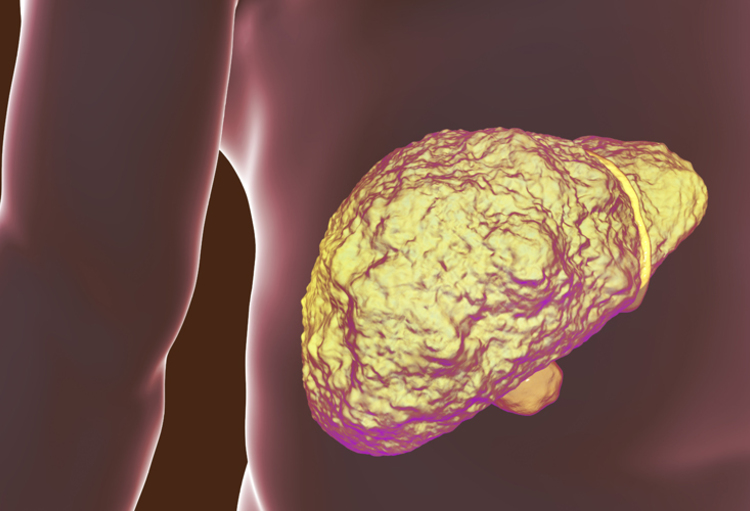 La Cirrhose Davantage Mortelle Que Les Cancers Du Poumon Colorectal De Lestomac Du Foie Et