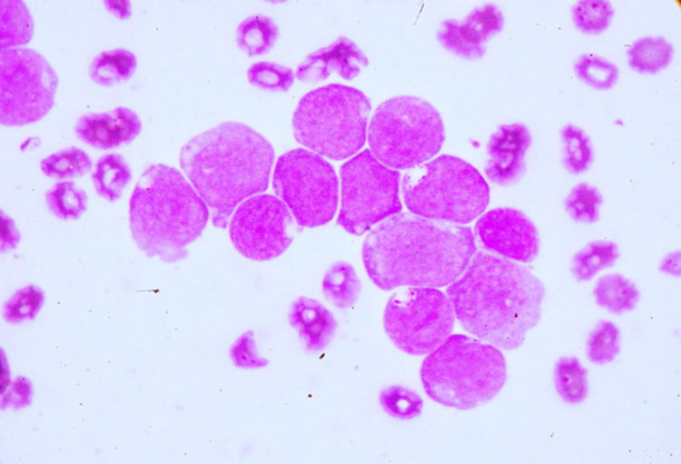 Leucémie virale: un nouvel outil pour mieux prédire la réponse au ...