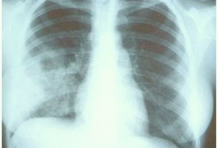 Trois fois plus de risques de contracter une infection fongique lors d ...