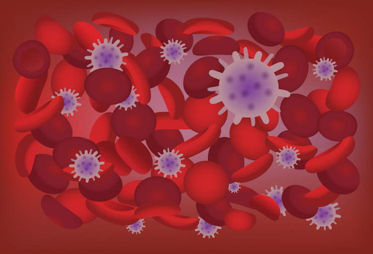 Infections: la septicémie associée à un décès sur cinq dans le monde ...