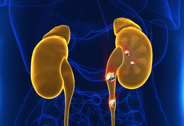 Antibioticatherapie en nierstenen: 5 risicoklassen - Medi-Sfeer